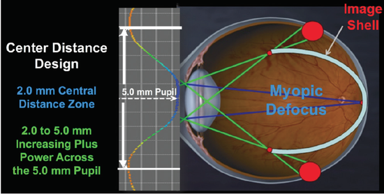 Myopia Control With Multifocal Contact Lenses