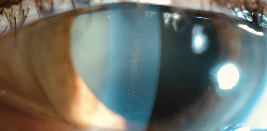 Pigmentary Dispersion Syndrome and Pigmentary Glaucoma