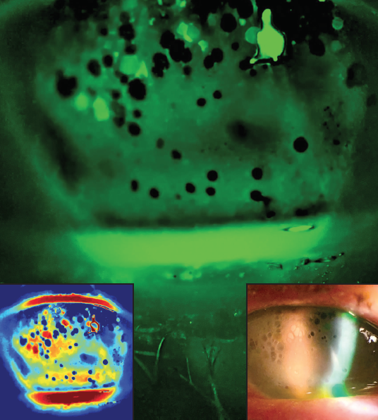 Bullous Keratopathy