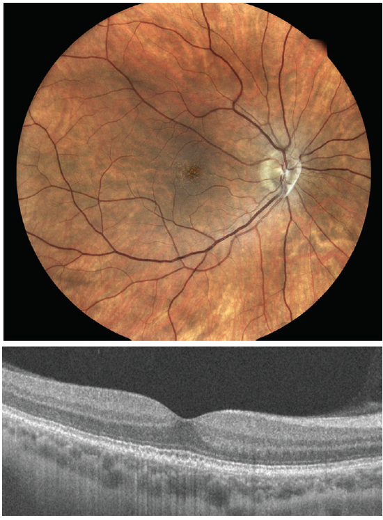 Sharpen Your AMD Diagnostic Skills