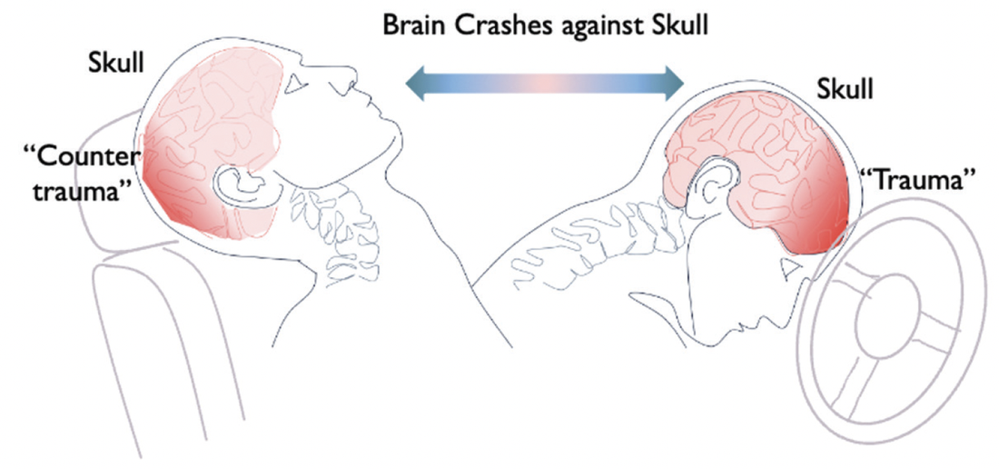 Navigating the Link Between Concussions and Glaucoma