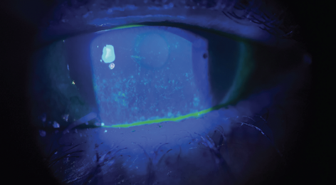 Bitot Spots