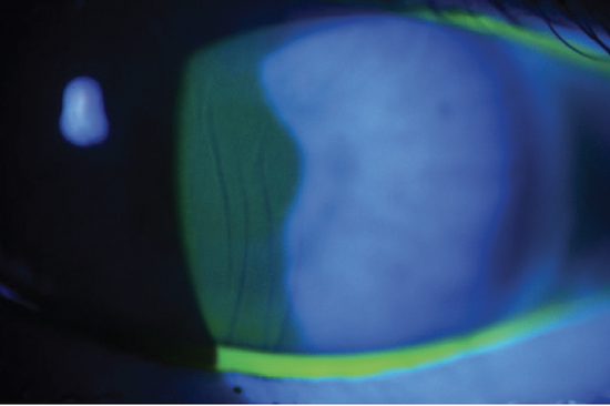The OD’s Role in Postoperative Refractive Surgery Care