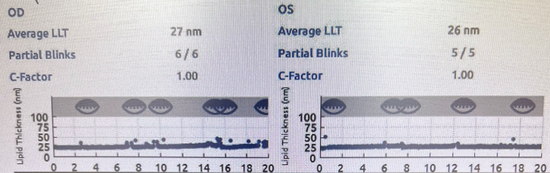 Breaking Down MGD Treatments Through the Lens of Sebac...