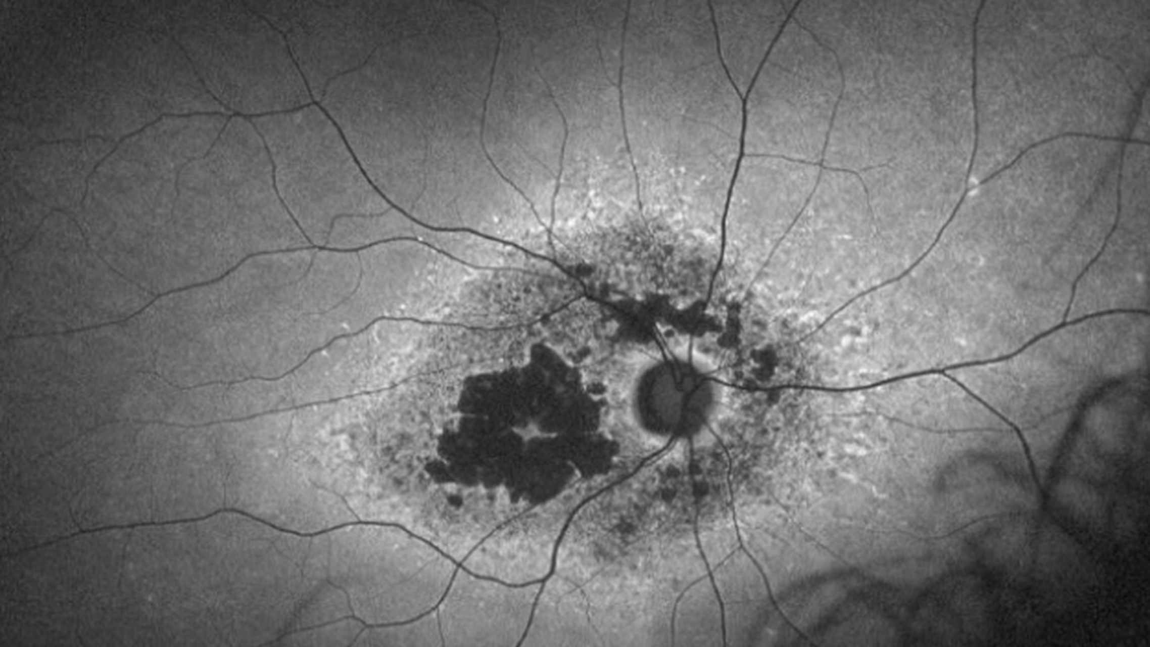 Stargardt Retinal Dystrophy - Modern Optometry