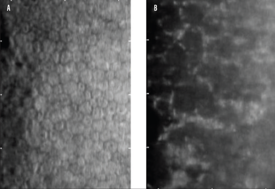 Corneal Endothelial Disease Intervention
