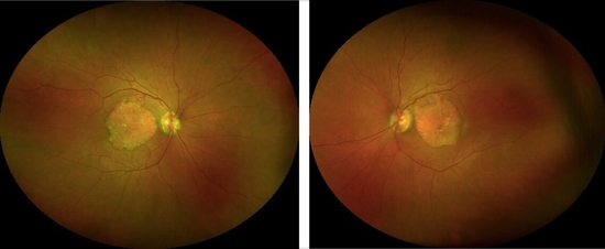 GA Case Compendium: Image Findings Suggesting Risk of Geo