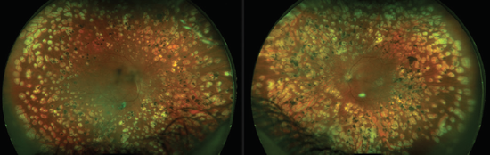 The Four Stages of Diabetic Retinopathy