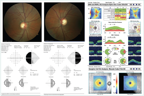 How to Recognize Glaucoma From Its Common Masqueraders