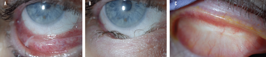 The Ocular Manifestations of GVHD