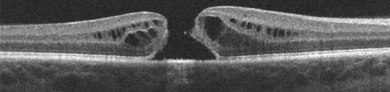 Know Your Vitreomacular Interface Disorders