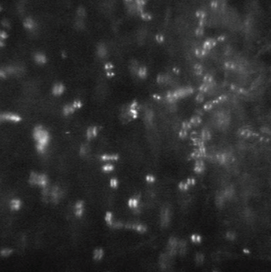 Infectious Crystalline Keratopathy