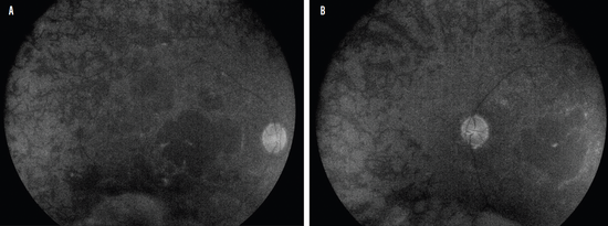 Managing a Case of Retinitis Pigmentosa