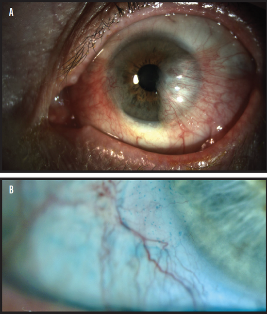 Key Identifiers in Cancerous Conjunctival Lesions