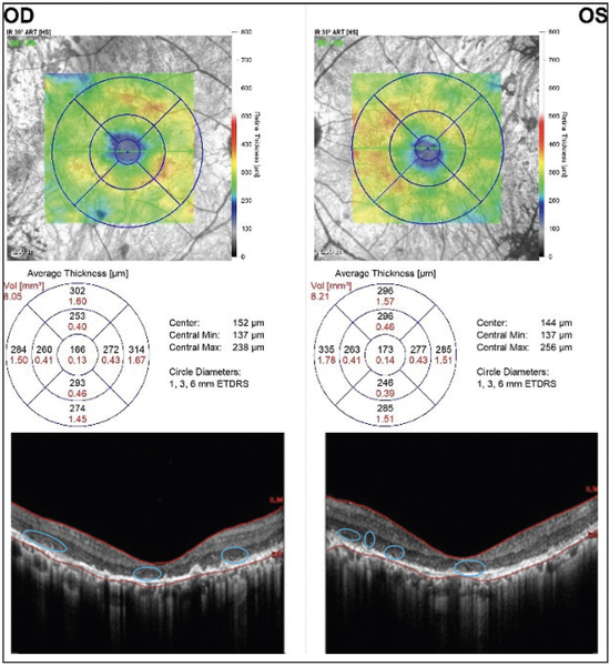 Managing a Case of Retinitis Pigmentosa