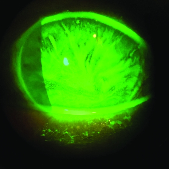 Limbal Stem Cell Deficiency