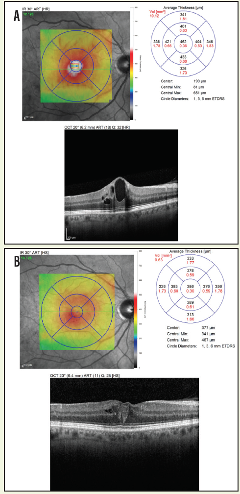 The Four Stages of Diabetic Retinopathy
