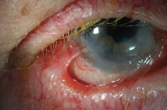 Managing Ocular Cicatricial Pemphigoid-Related OSD