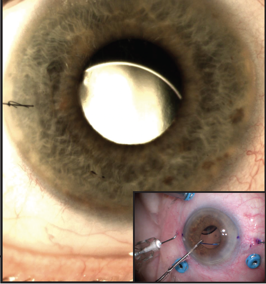 Techniques for Repairing Dislocated IOL