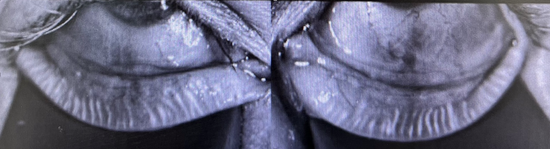 Breaking Down MGD Treatments Through the Lens of Sebac...