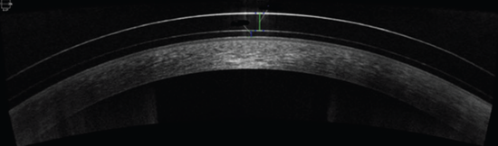 Scleral Lens Fitting Tips and Tricks