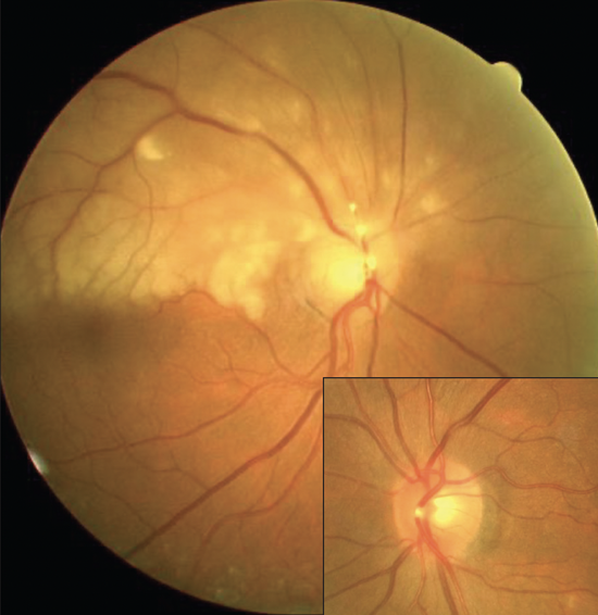 An Ocular Sign of Cardiovascular Disease