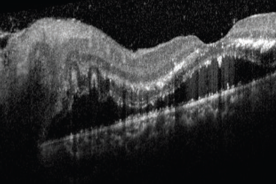 Neuroretinitis From Cat Scratch Disease