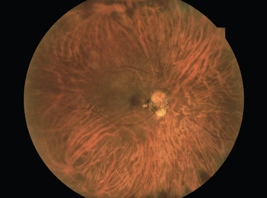 Beyond the Diopter: Myopia’s Mark on the Retina and Ch...