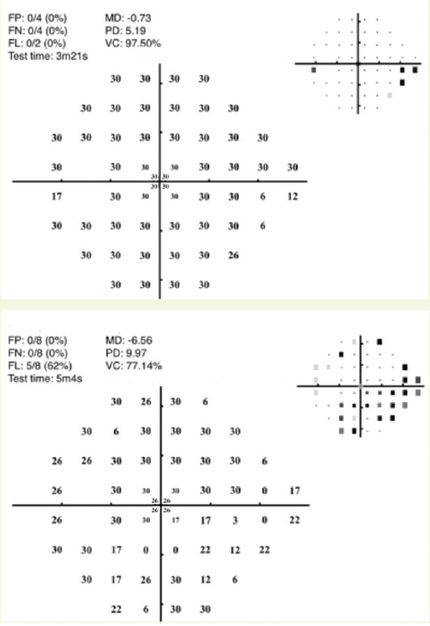 A New Era in Visual Field Testing