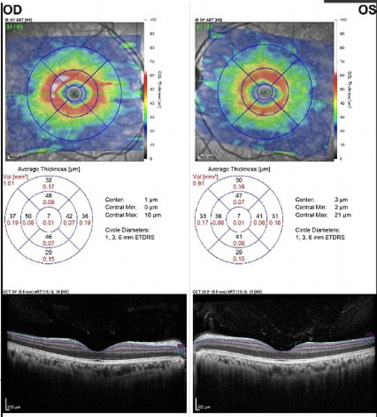 Ocular Effects of Pituitary Tumor