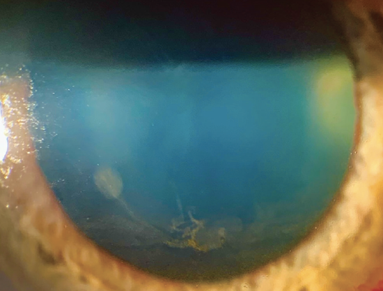 The Expanding Differential of Corneal Verticillata