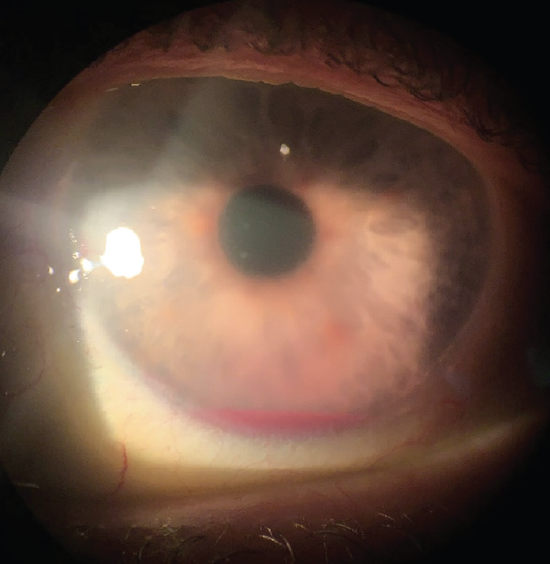 The OD’s Role in Glaucoma Surgical Care