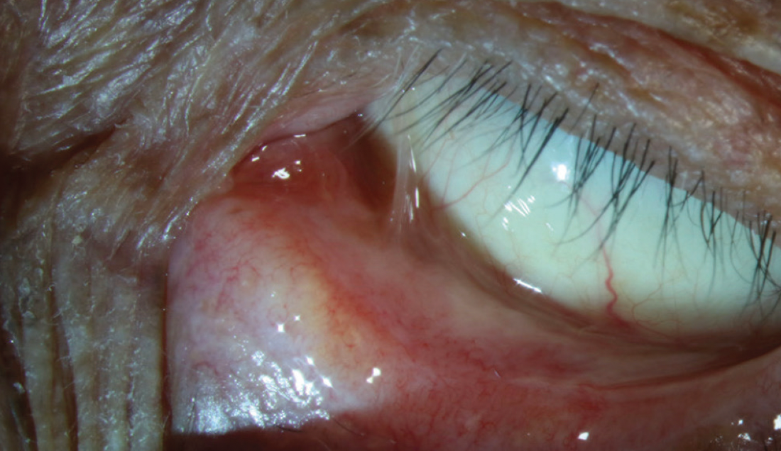 Managing Ocular Cicatricial Pemphigoid-Related OSD