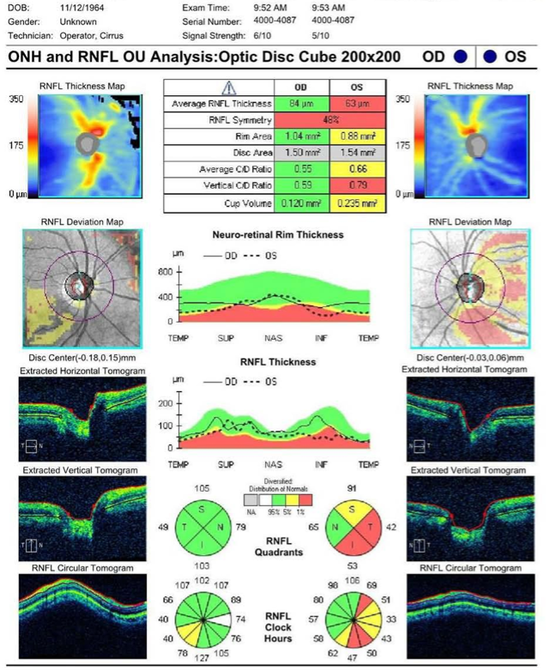 Is it Glaucoma? Perimetry Cracked the Case - Modern Optometry