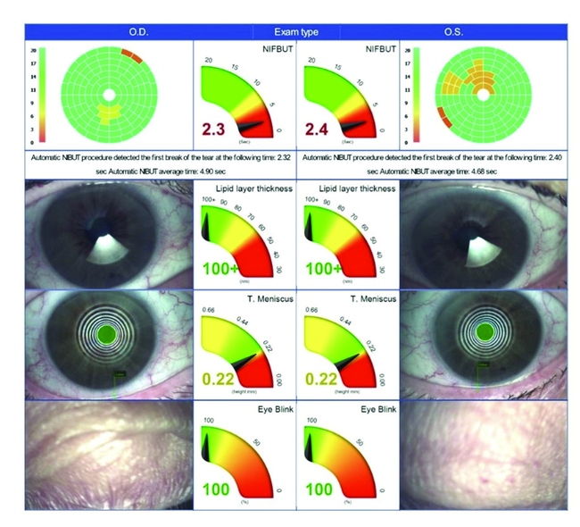 Imaging for Evaporative DED - Modern Optometry