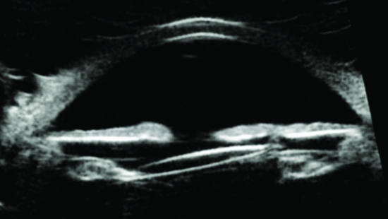 UGH Syndrome: When Implants Fight Back - Modern Optometry