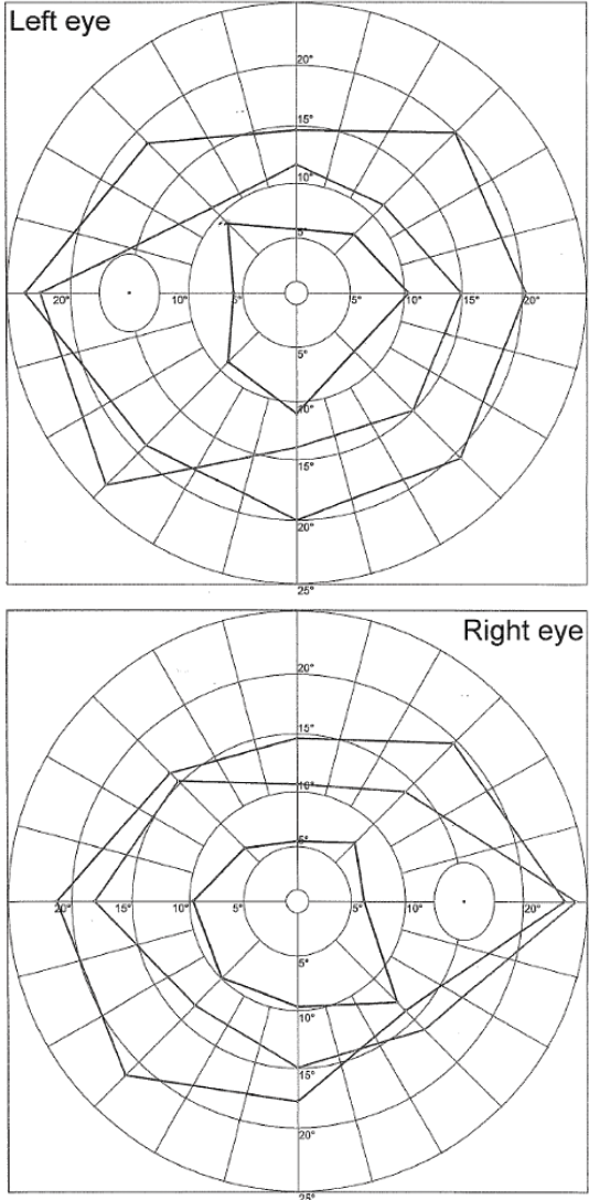 Visual Consequences of Mild Traumatic Brain Injury