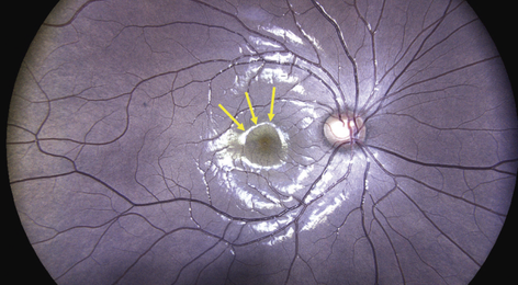 The Four Stages of Diabetic Retinopathy