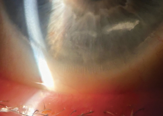 The Skinny on Salzmann Nodular Degeneration