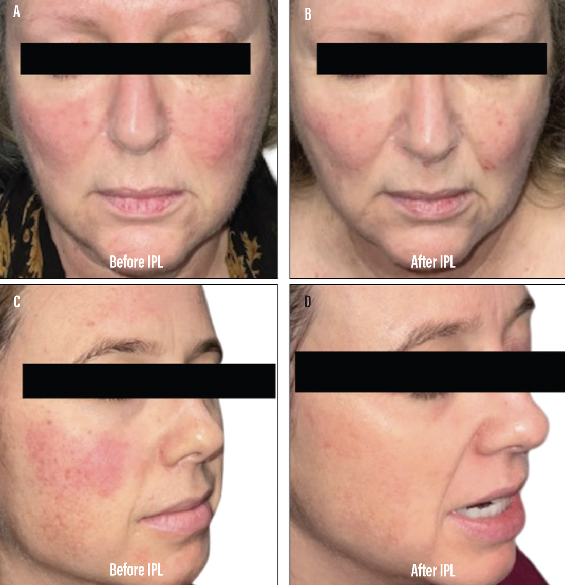 IPL Therapy and Ocular Rosacea