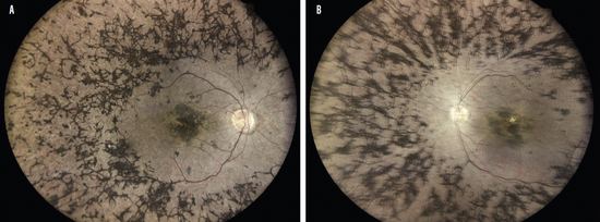 Managing a Case of Retinitis Pigmentosa