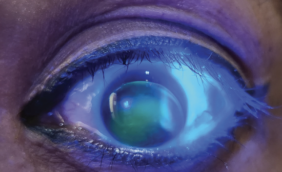 Specialty Lenses for Vision Rehabilitation