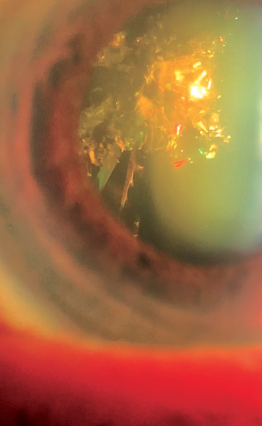 Christmas Tree Cataract