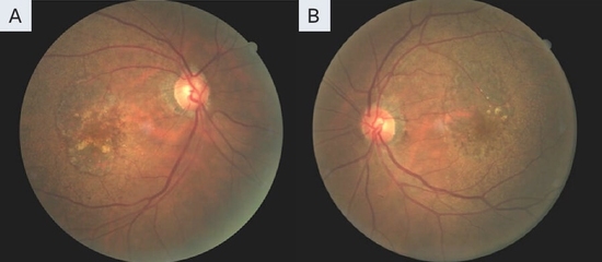 GA Case Compendium: Multimodal Imaging for Following Geo
