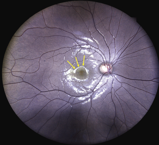 Commotio Retinae in a Teenager