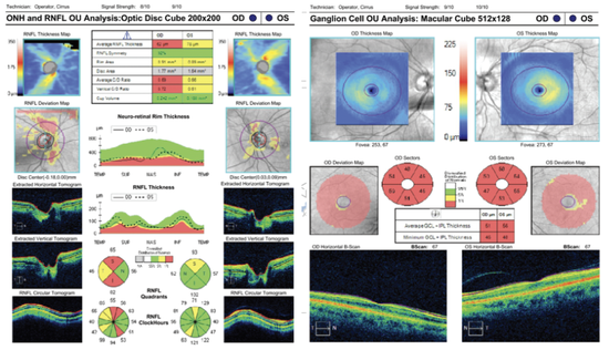 Meningioma Masquerader - Modern Optometry