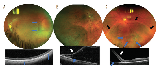 The Usual (Retina) Suspects