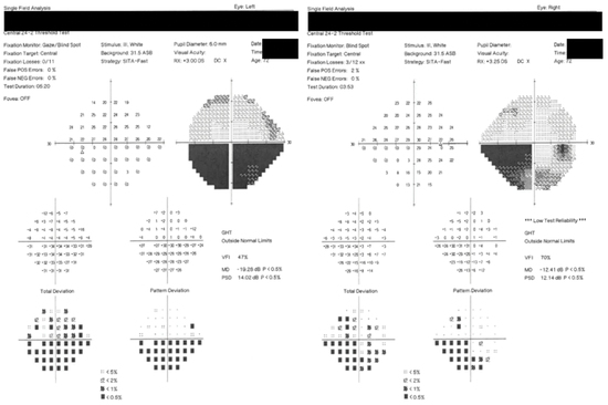 A Case of Multiple Visual Field Defects Secondary to G...