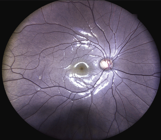 Commotio Retinae in a Teenager