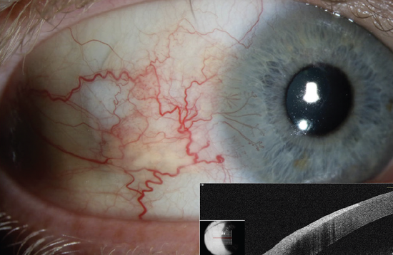 Ocular Surface Squamous Neoplasia in an Avid Sailor Wi...